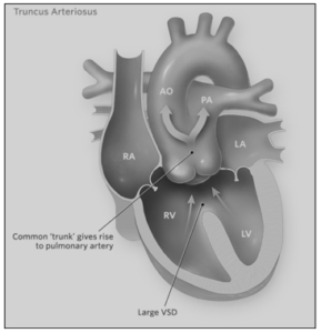 Hemitruncus arteriosus: una patologia cardiaca congenita.