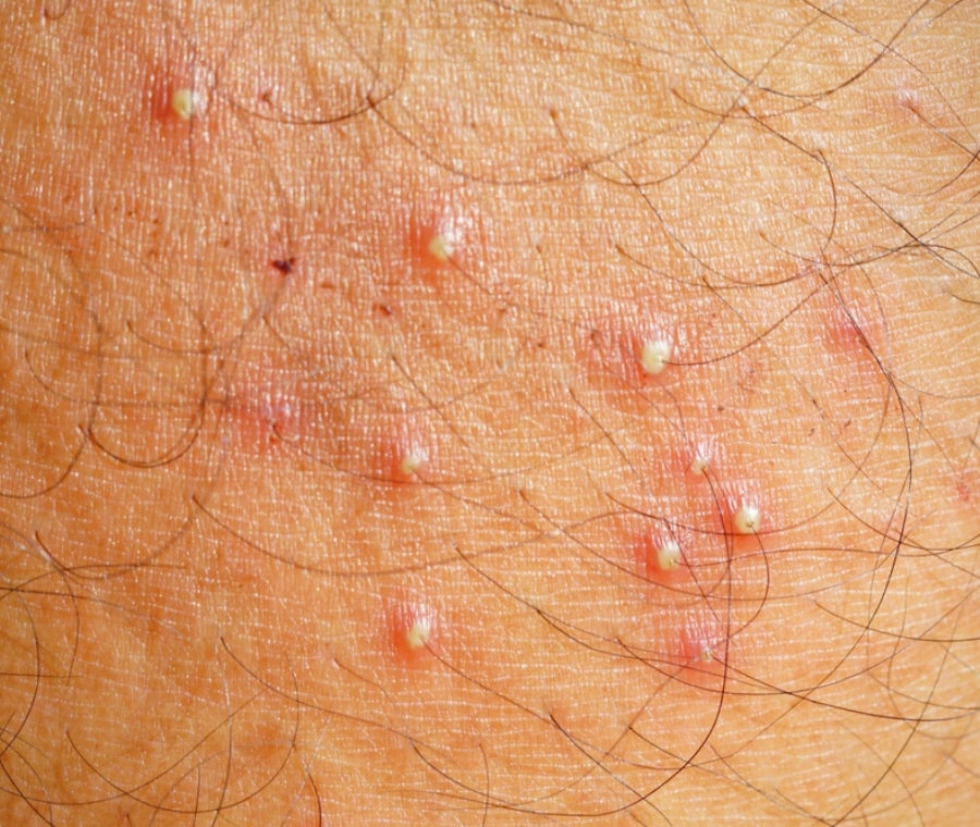 Follicolite pustolosa eosinofila di tipo classico