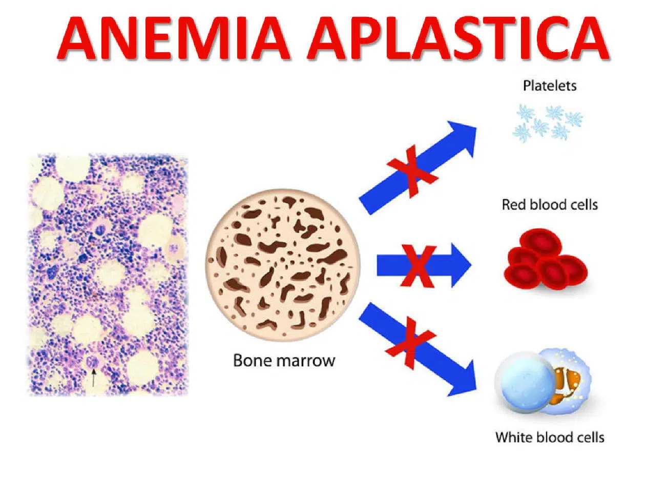 Anemia Aplastica Isolata Ereditaria: una Patologia Medica.