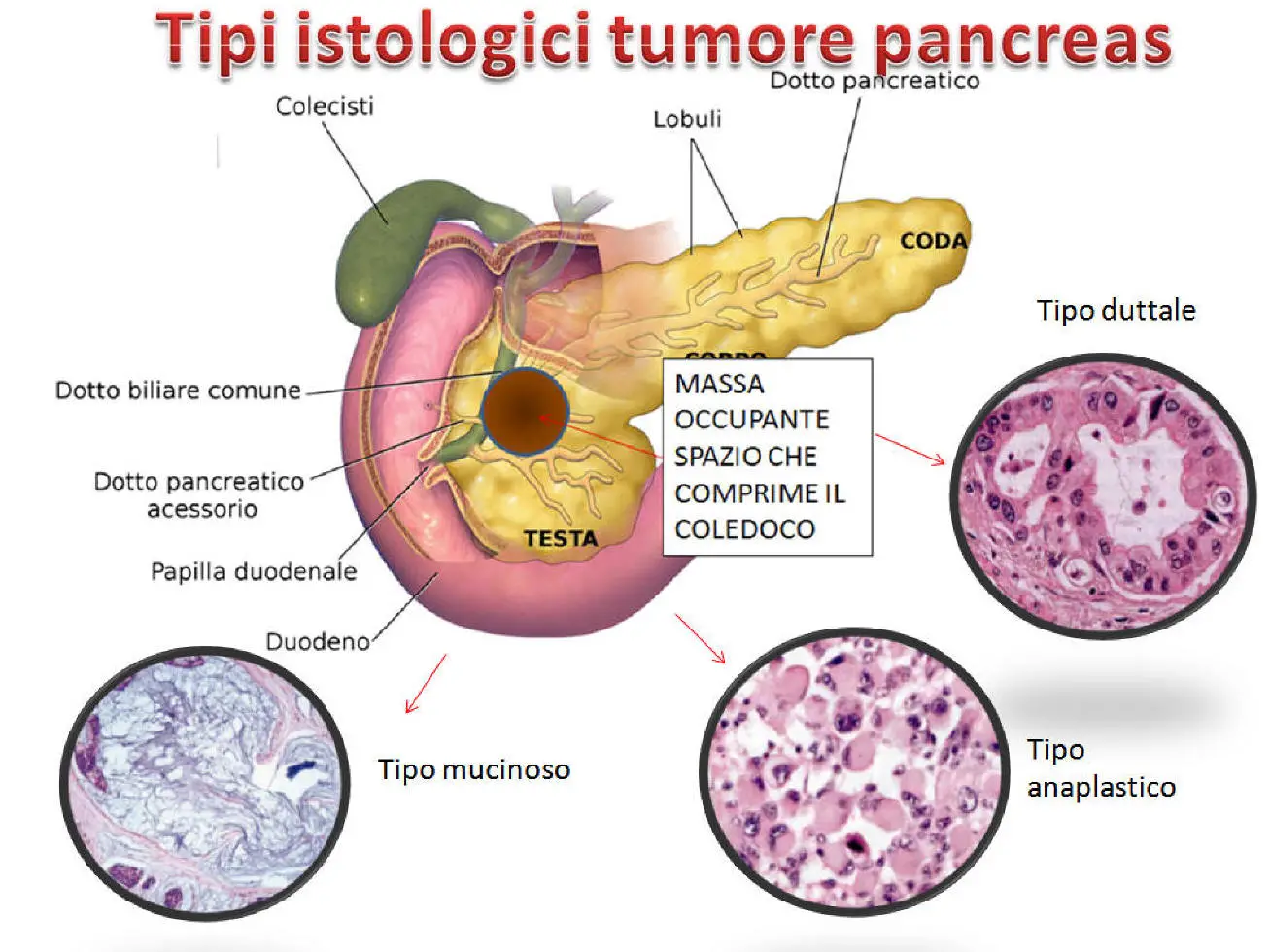 Carcinoma della Pancreatica a Cellule Squamose