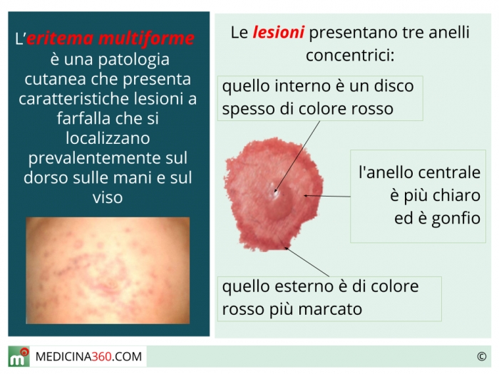 Eritema Multiforme Maggiore: Una Patologia Cutanea Infiammatoria