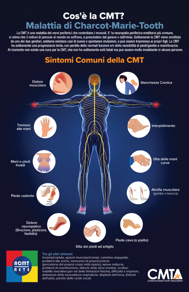 Sindrome di Charcot Marie Tooth